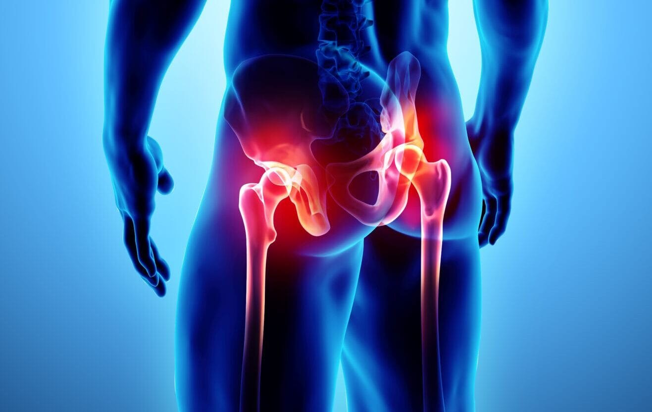 Slijmbeursontsteking in de heup - Running Solutions